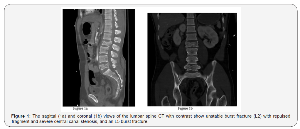 Post-Operative Paralumbar Pseudoaneurism: A Case Report | Iris Publishers