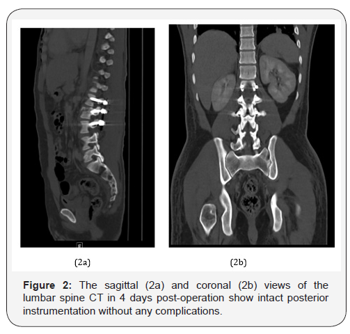Post-Operative Paralumbar Pseudoaneurism: A Case Report | Iris Publishers